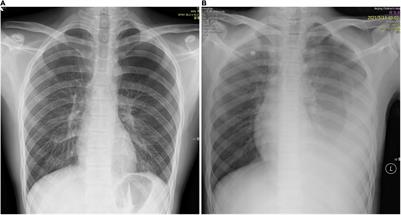Left Hemothorax X Ray